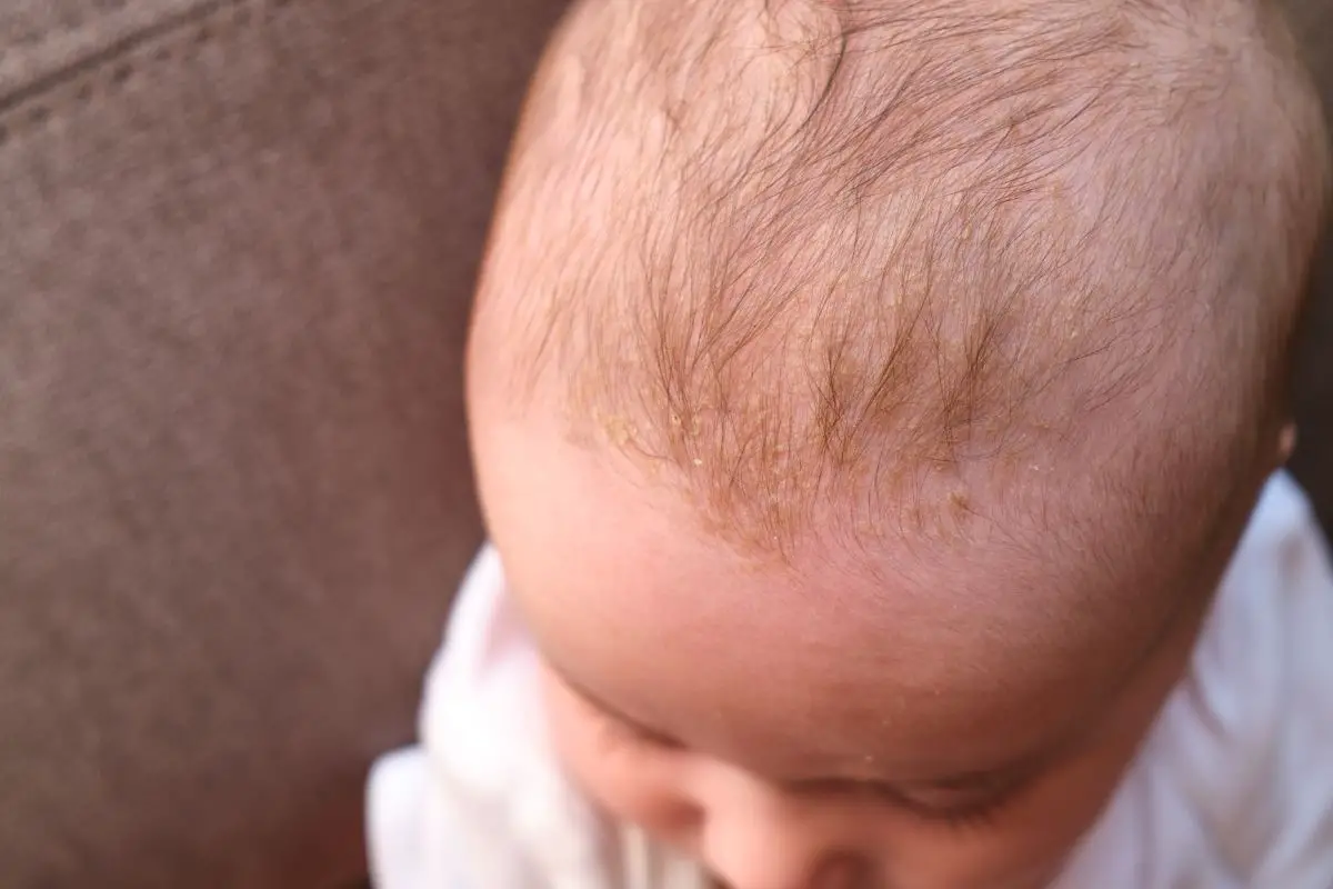Understanding Cradle Cap: Symptoms, Causes, and Treatment ...