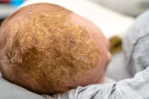 Understanding Cradle Cap: Symptoms, Causes, and Treatment ...